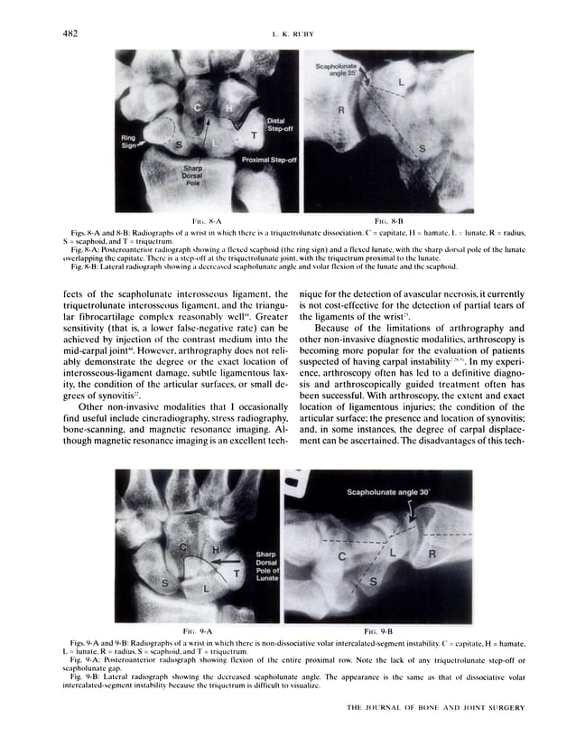 Carpal instability | PDF