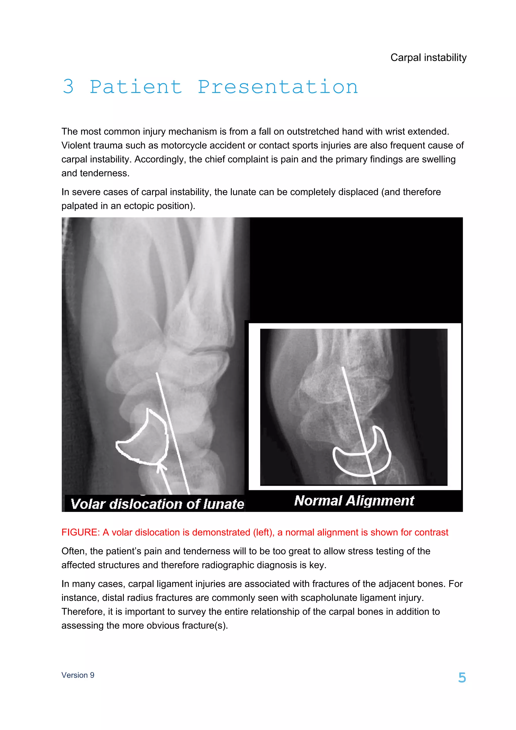 Carpal instability | PDF