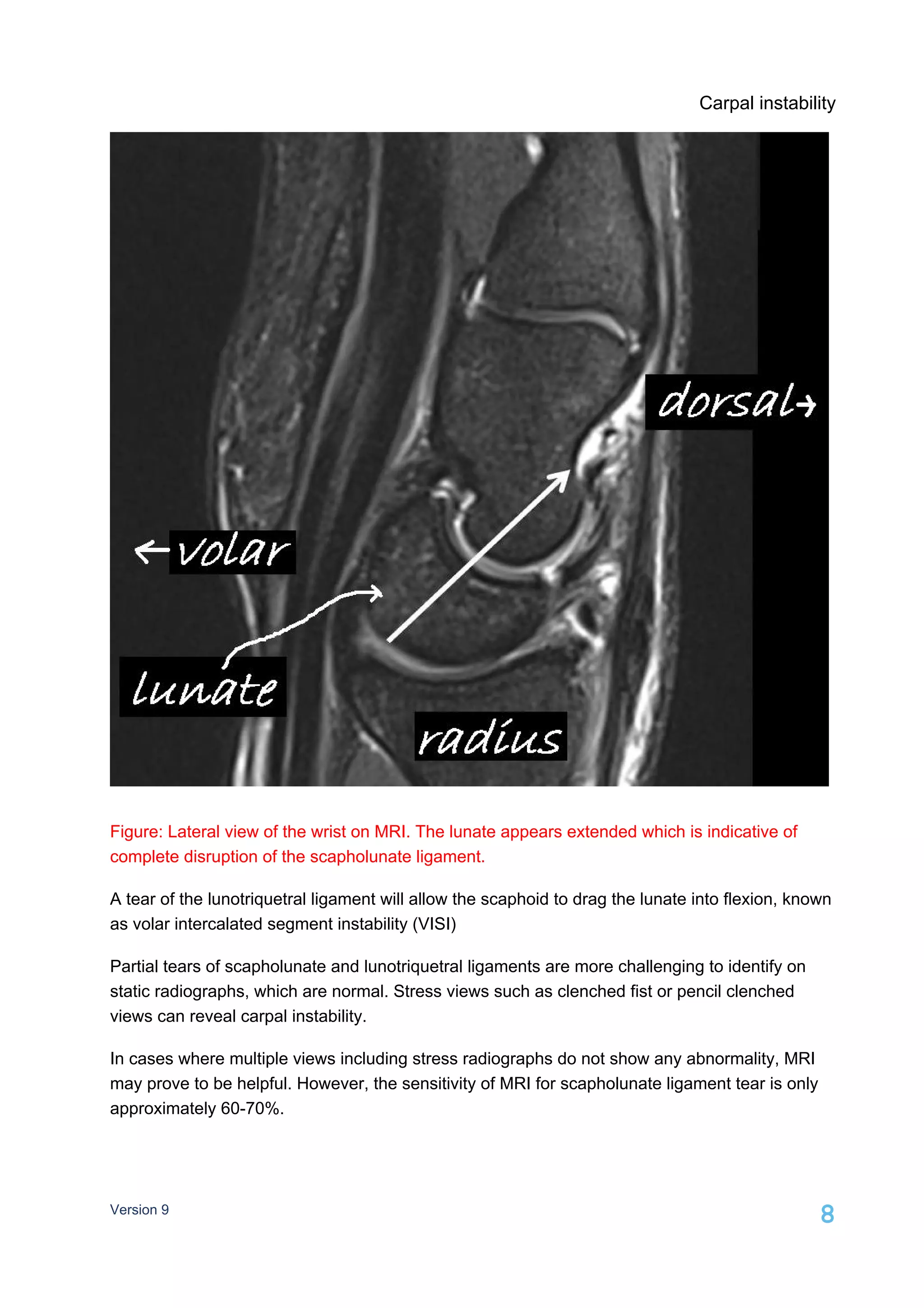 Carpal instability | PDF