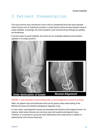Carpal instability | PDF
