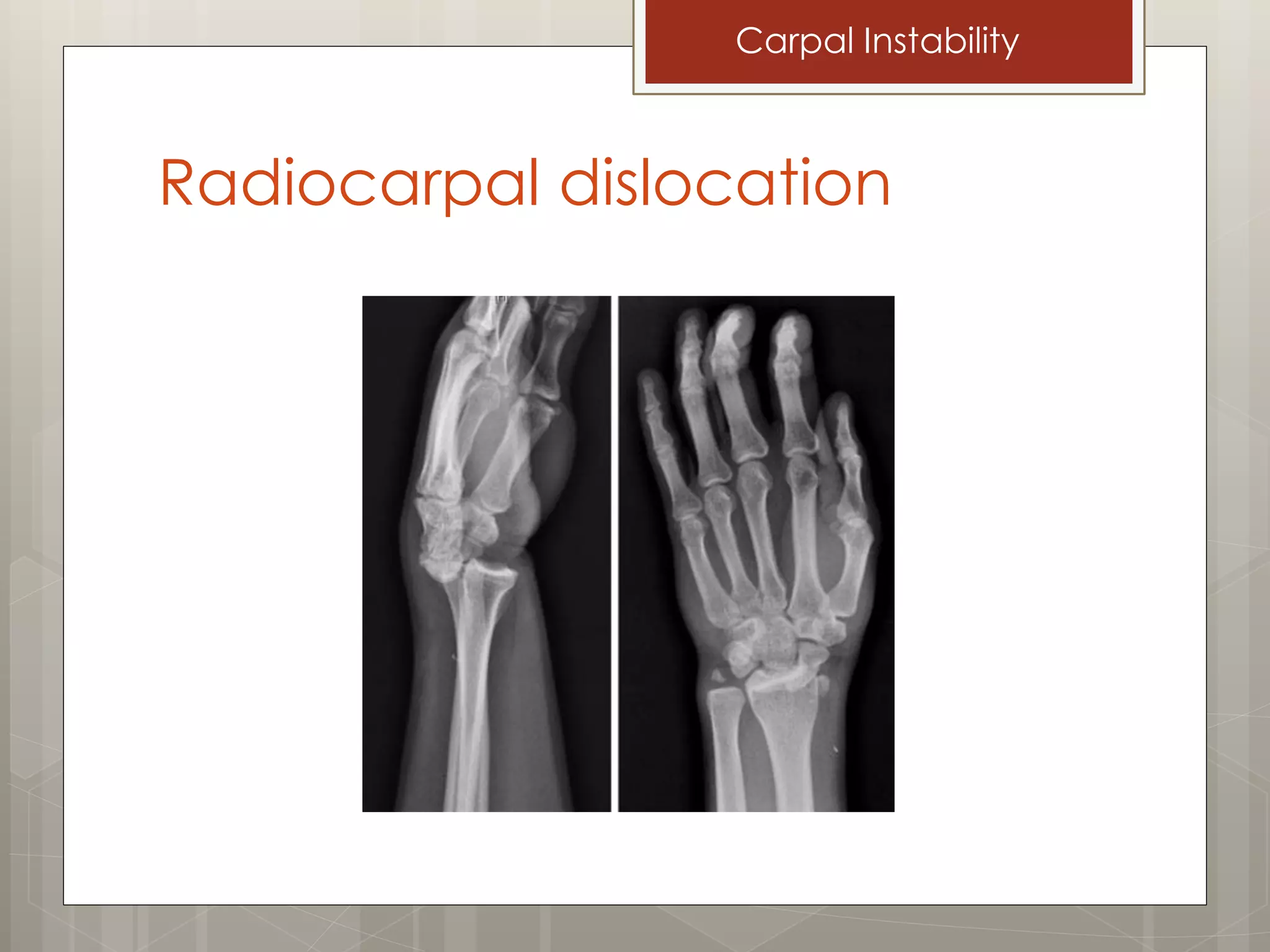 Carpal instability - Orthopedic | PDF