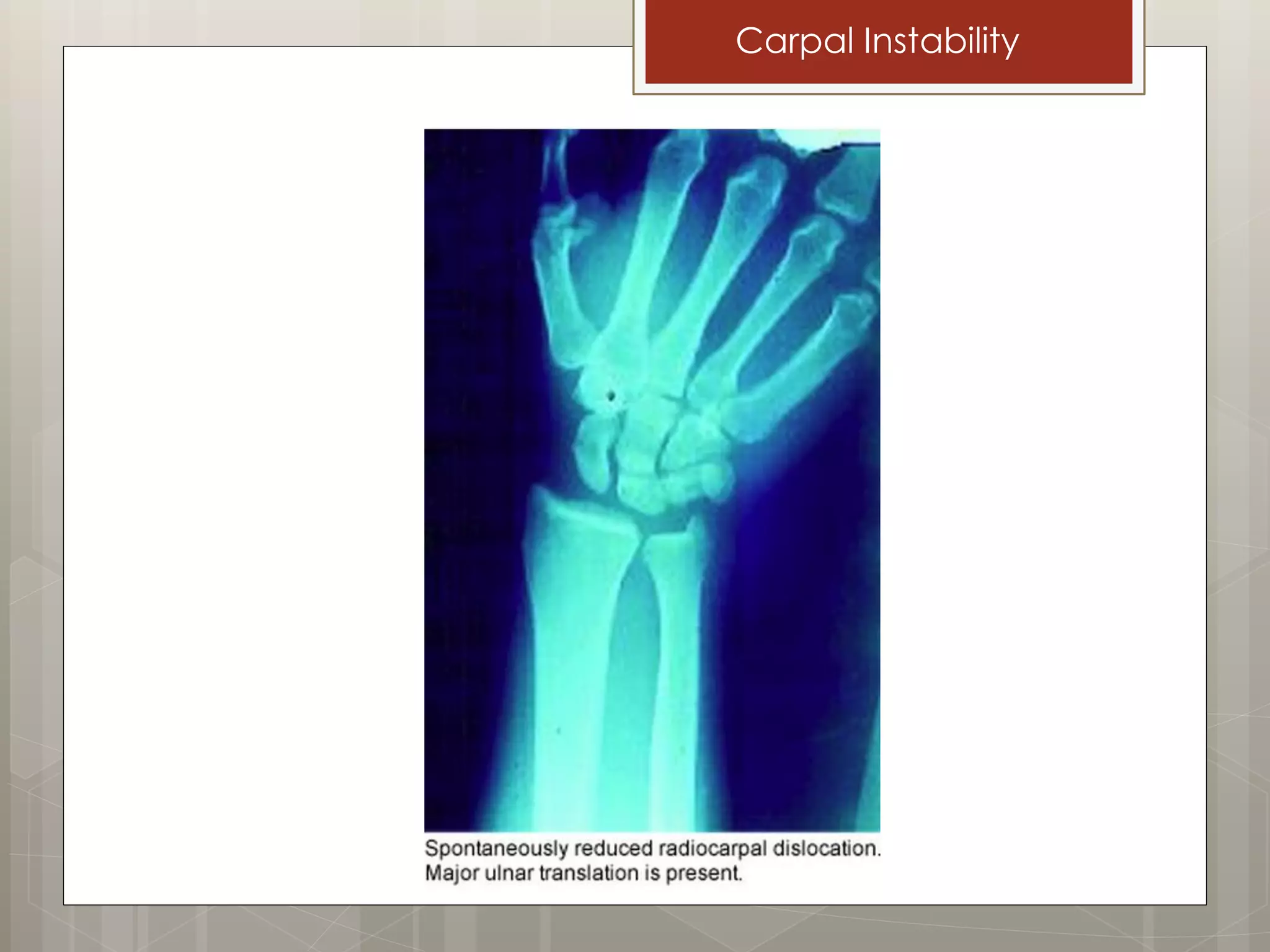 Carpal instability - Orthopedic | PDF