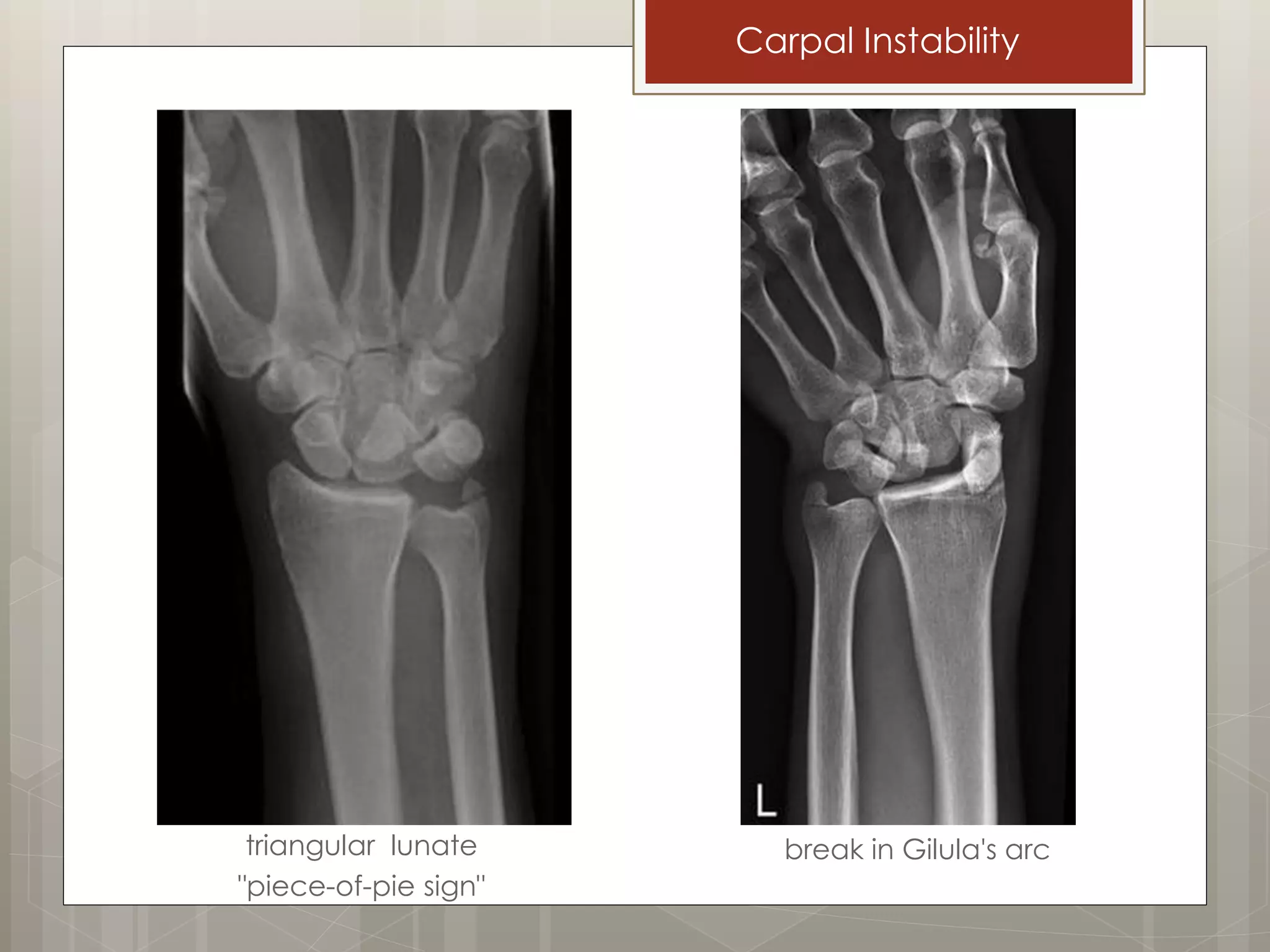 Carpal instability - Orthopedic | PDF