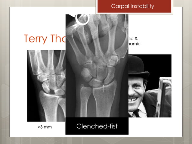Carpal instability - Orthopedic | PDF