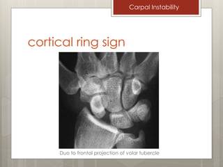 Carpal instability - Orthopedic | PDF