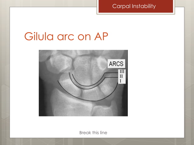 Carpal instability - Orthopedic | PDF