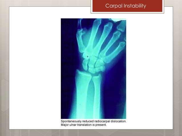 Carpal instability - Orthopedic | PDF