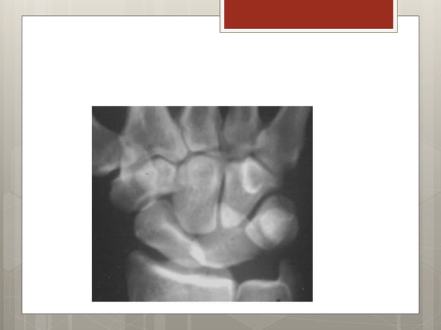 Carpal instability - Orthopedic | PDF
