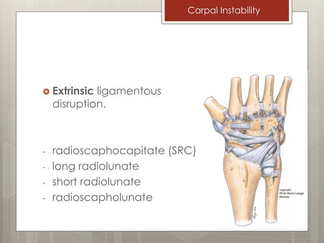 Carpal instability - Orthopedic | PPT