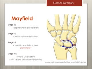 Carpal instability - Orthopedic | PPT
