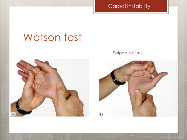 Carpal instability - Orthopedic