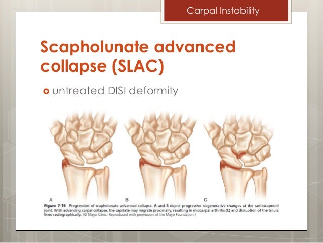Carpal instability - Orthopedic