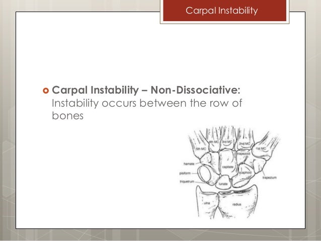 Carpal instability - Orthopedic