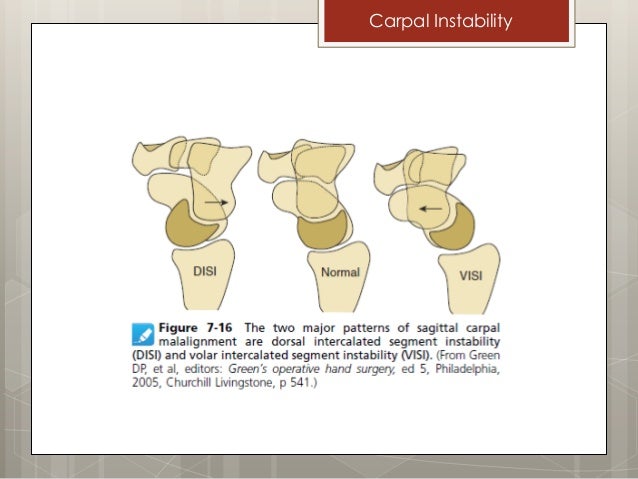Carpal instability - Orthopedic