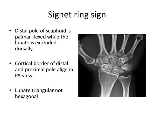 Carpal instability