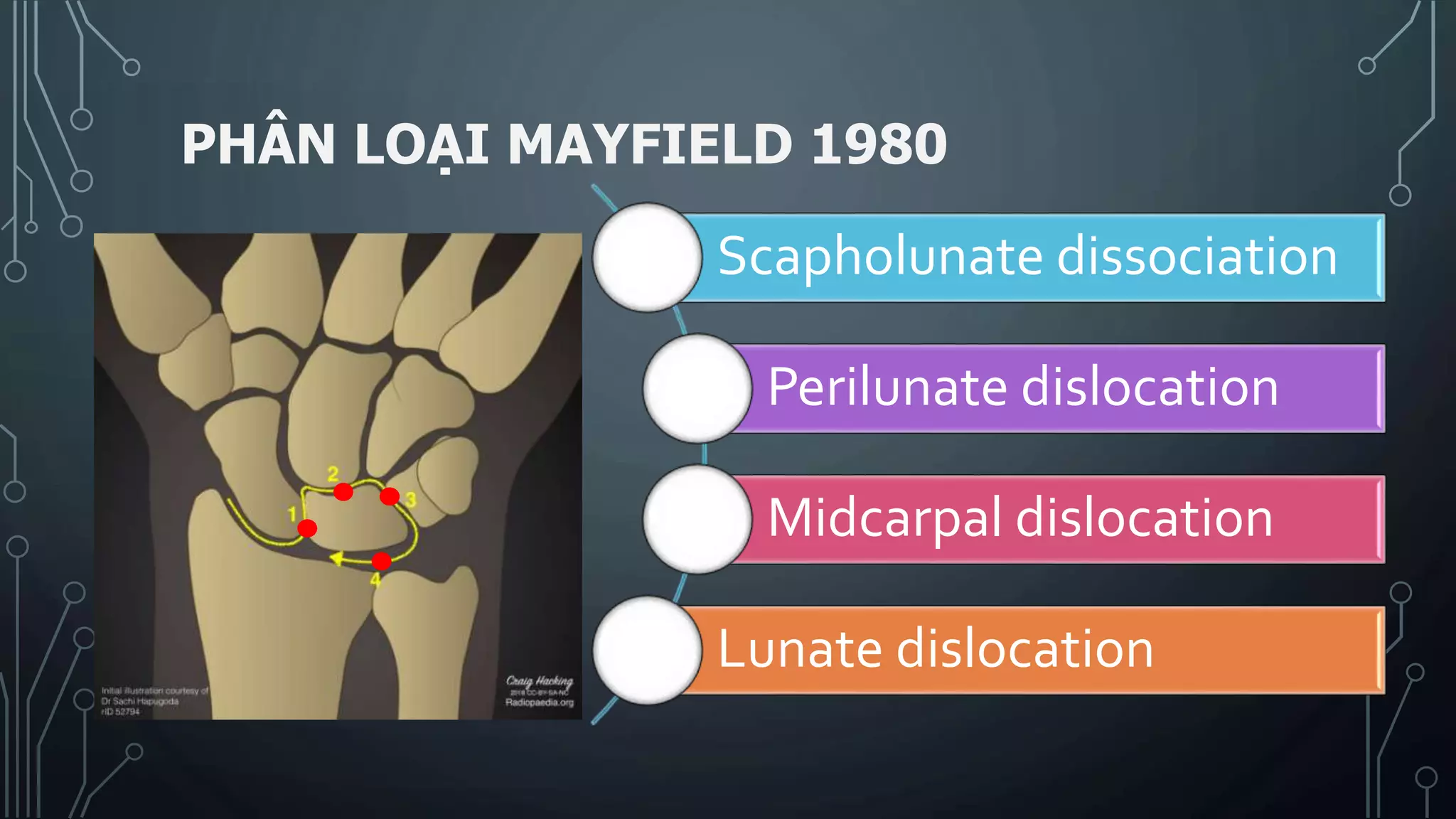 Carpal instability - mất vững khớp cổ tay | PPTX