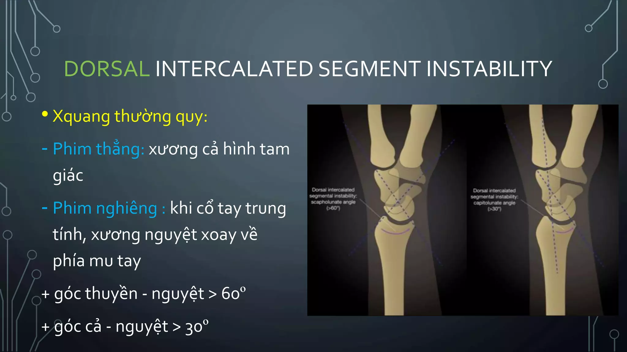 Carpal instability - mất vững khớp cổ tay | PPTX