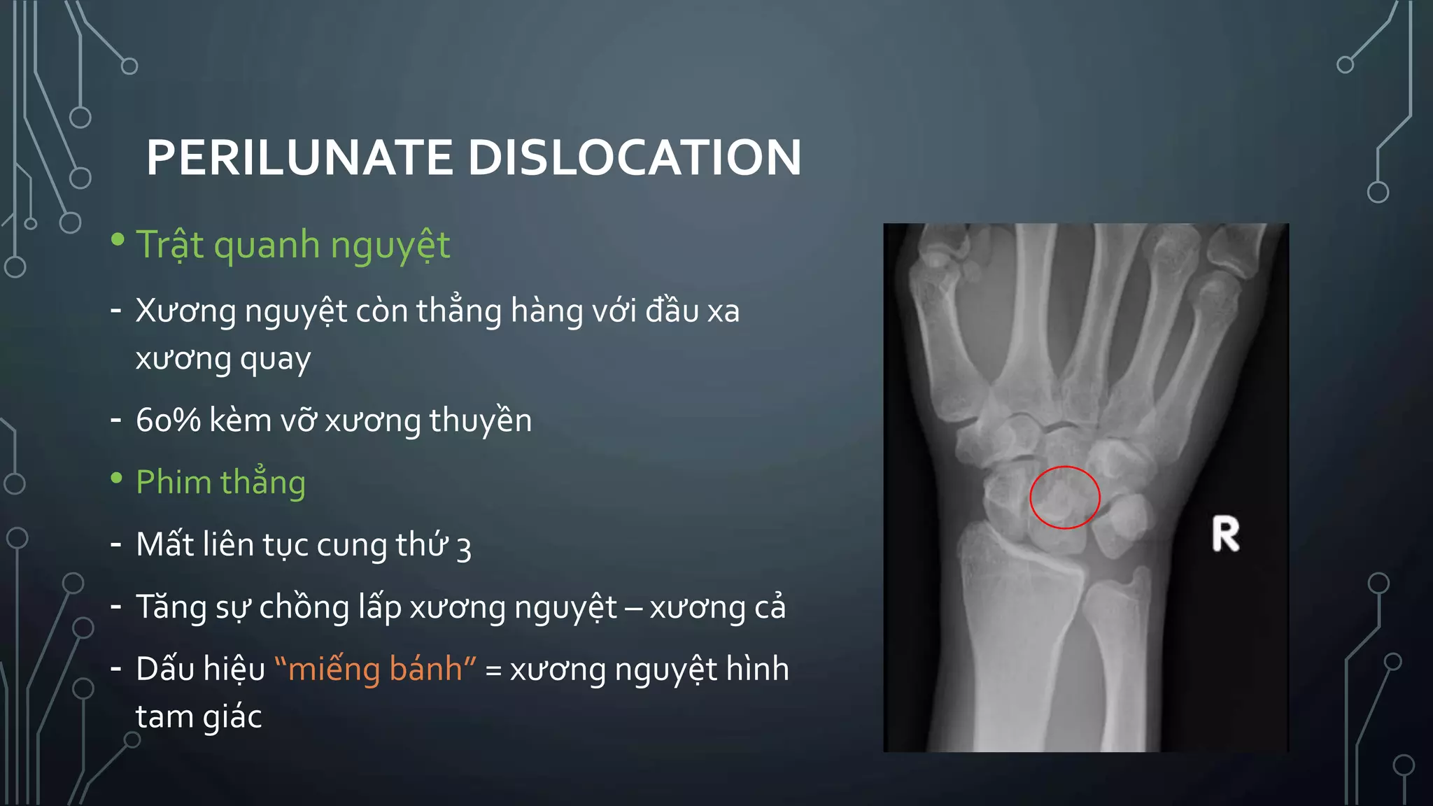 Carpal instability - mất vững khớp cổ tay | PPTX
