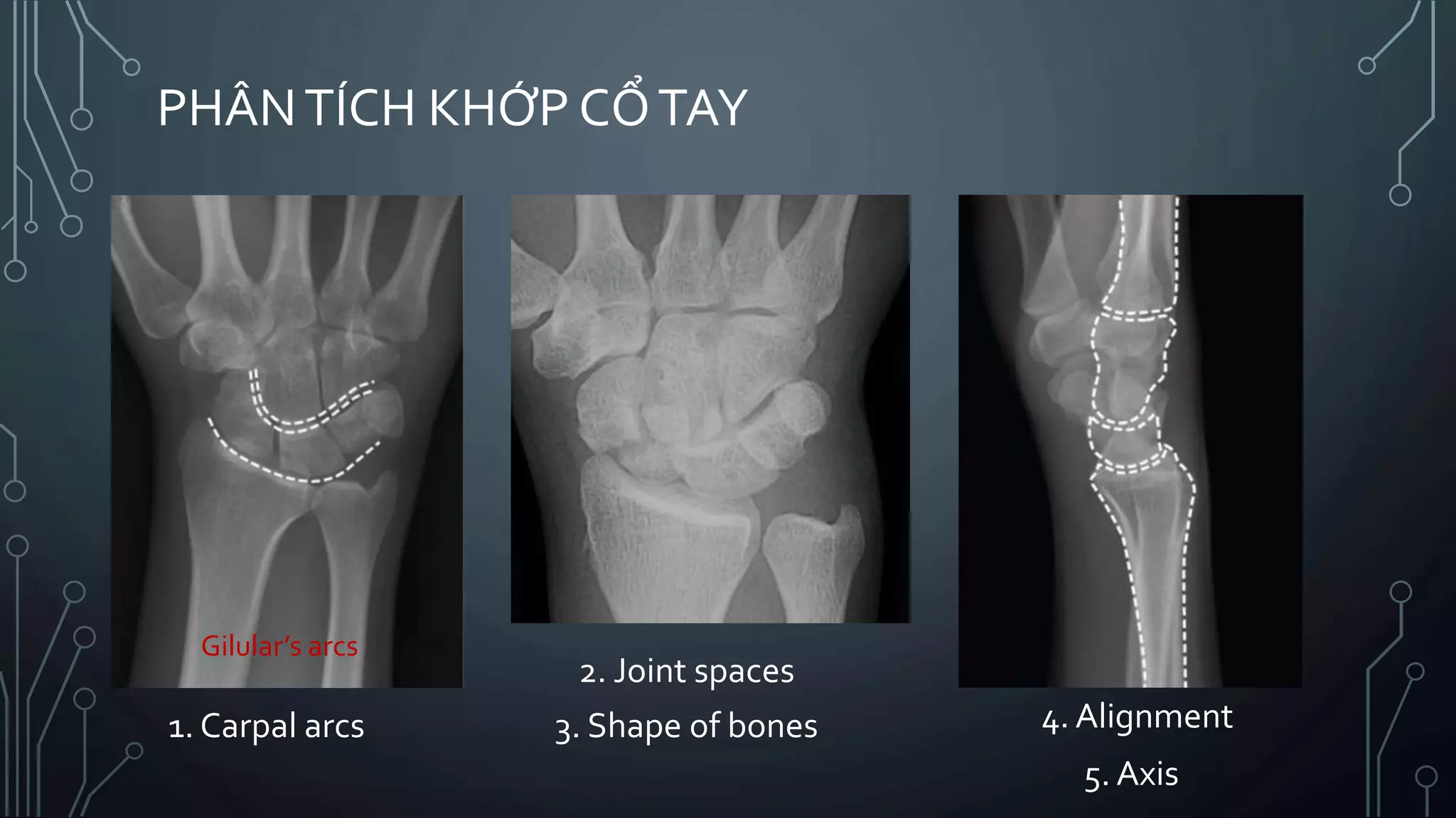 Carpal instability - mất vững khớp cổ tay | PPTX