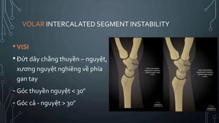 Carpal instability - mất vững khớp cổ tay | PPTX