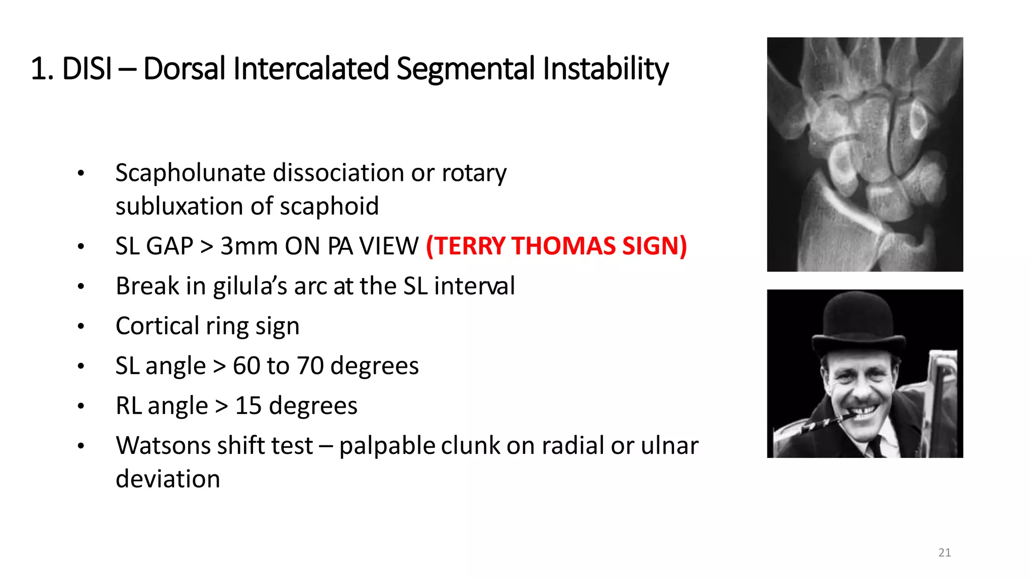 carpal instability & management.pptx