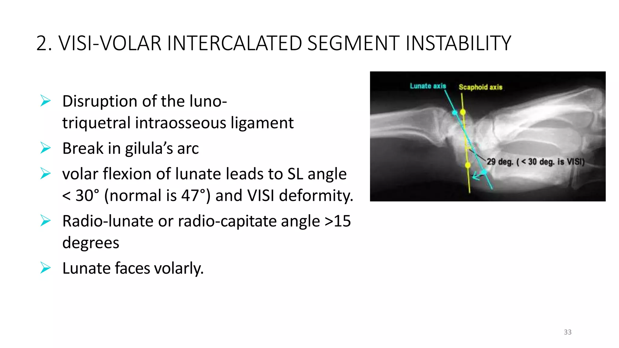 carpal instability & management.pptx