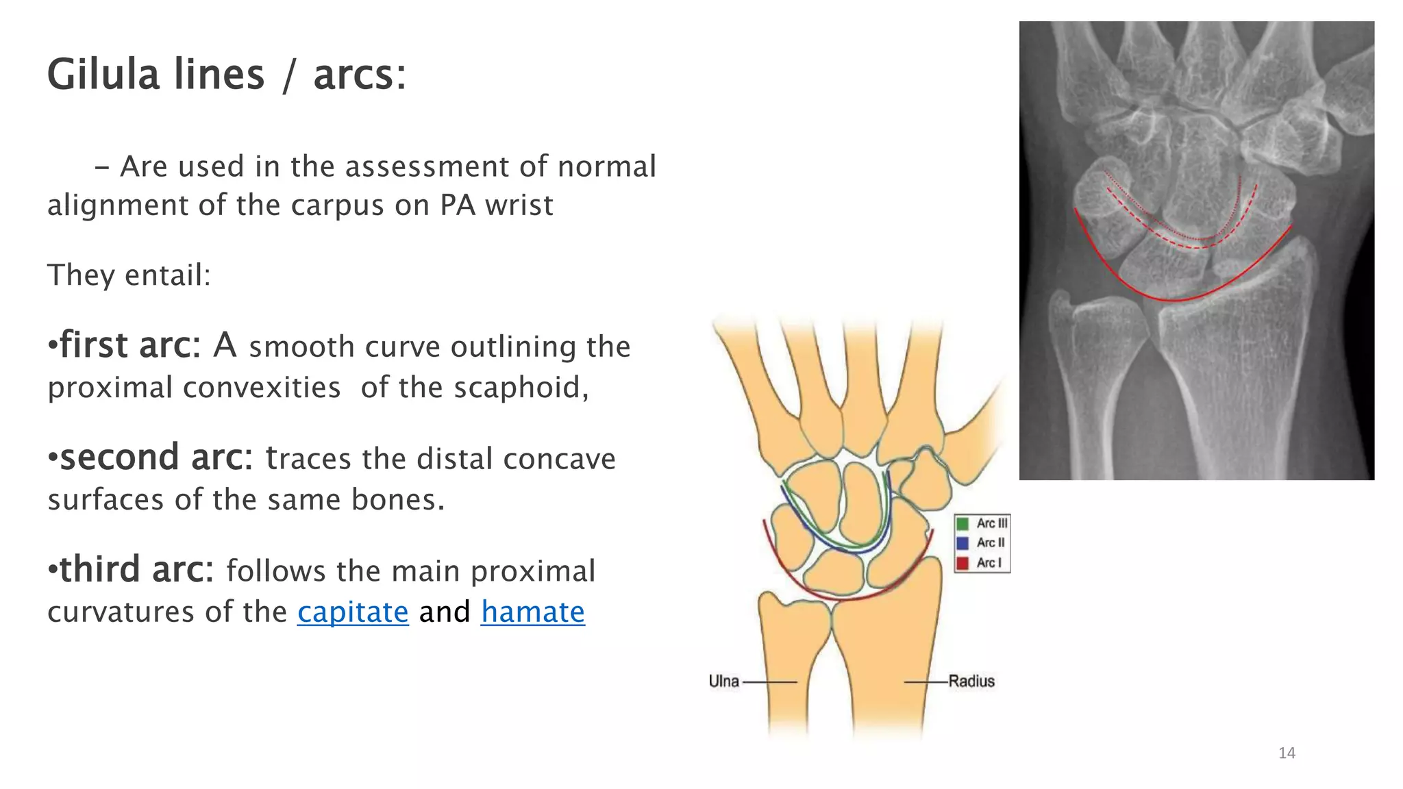 carpal instability & management.pptx