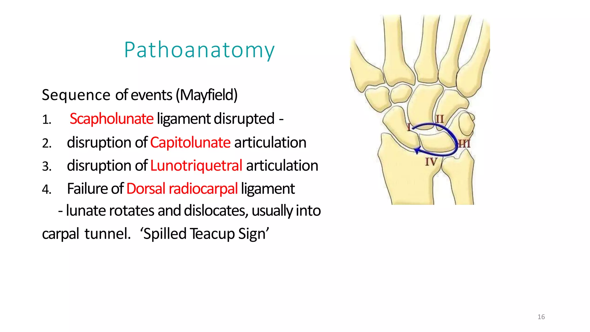 carpal instability & management.pptx