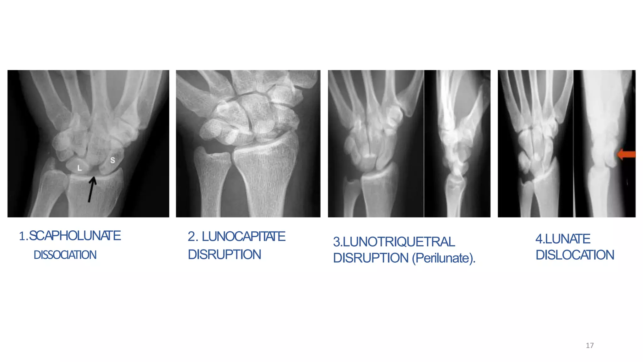 carpal instability & management.pptx