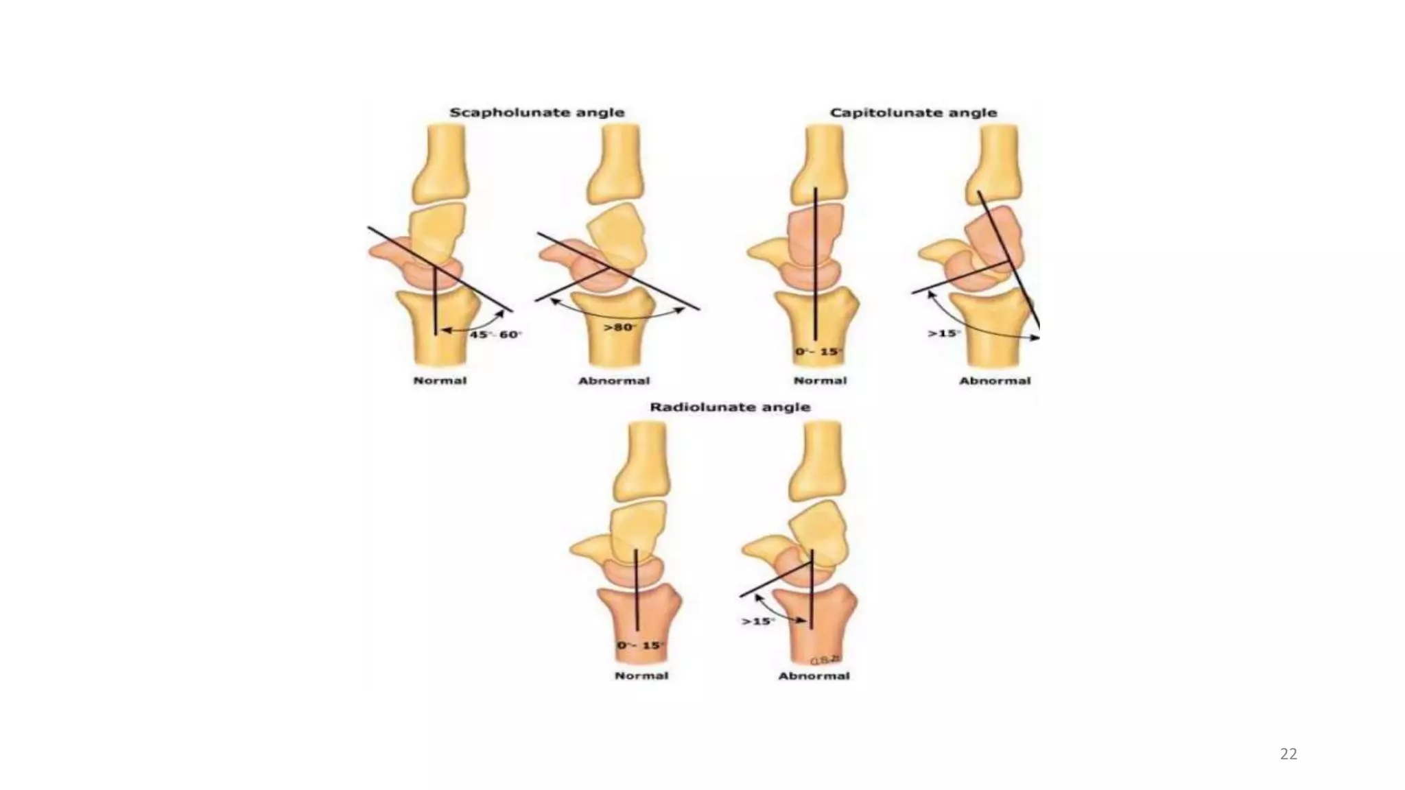 carpal instability & management.pptx