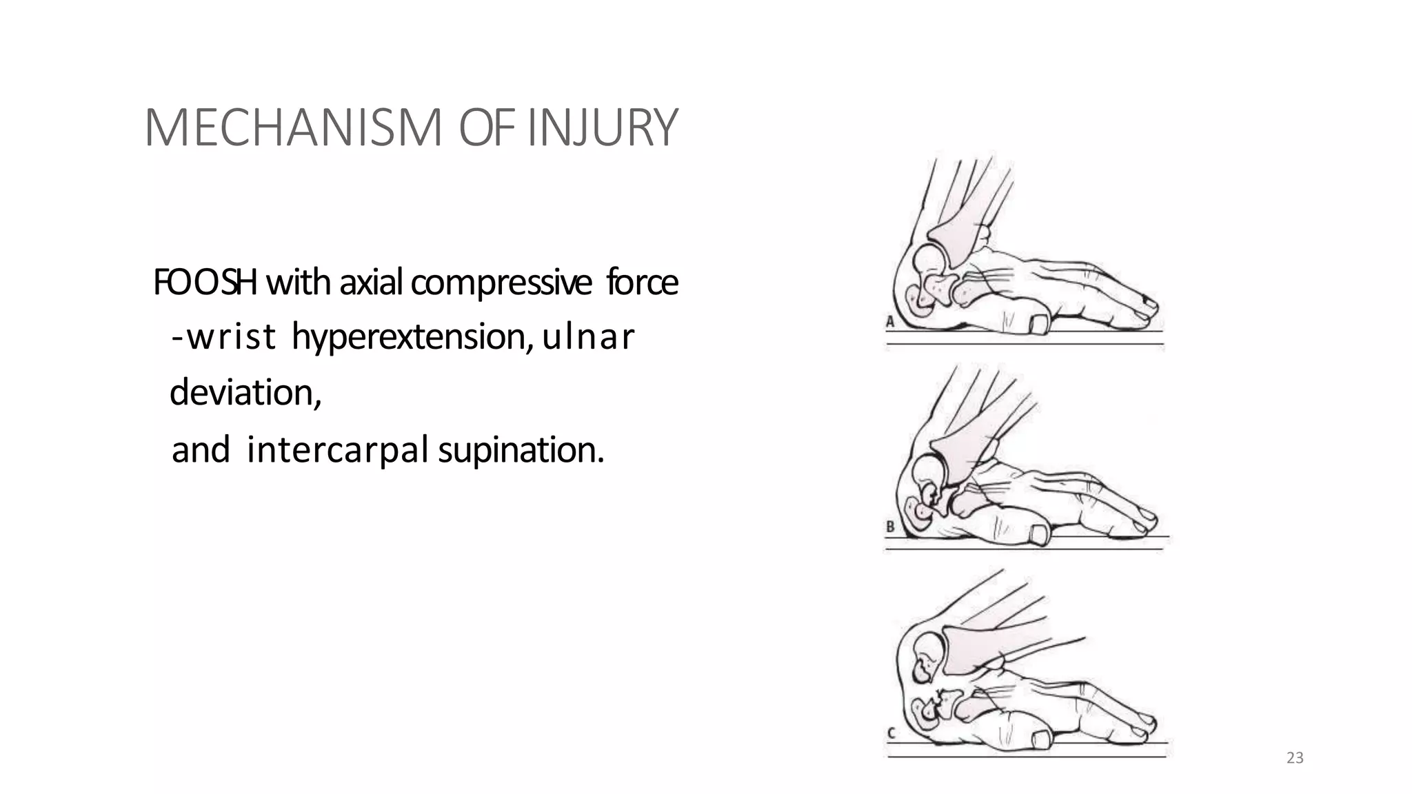 carpal instability & management.pptx