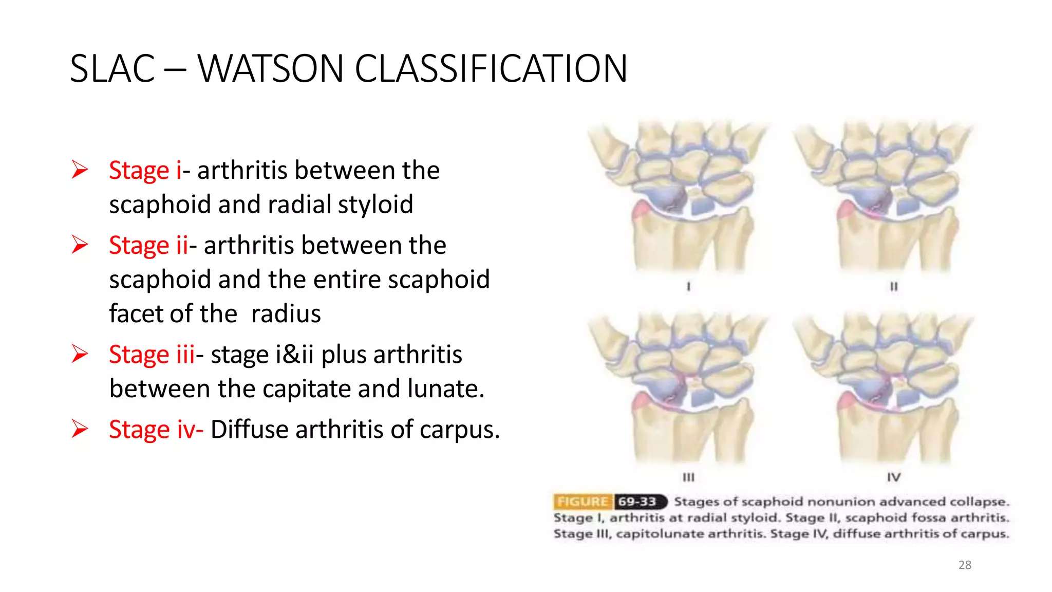 carpal instability & management.pptx