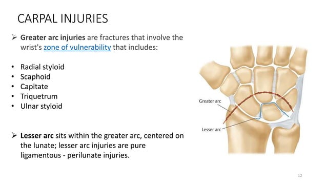 carpal instability & management.pptx