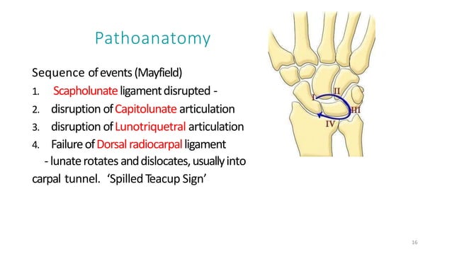 carpal instability & management.pptx