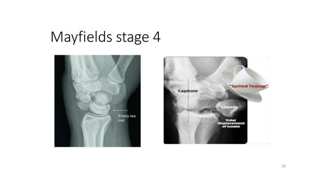 carpal instability & management.pptx