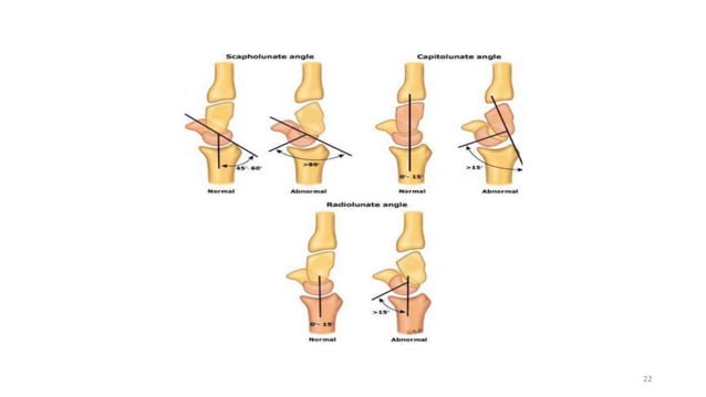 carpal instability & management.pptx