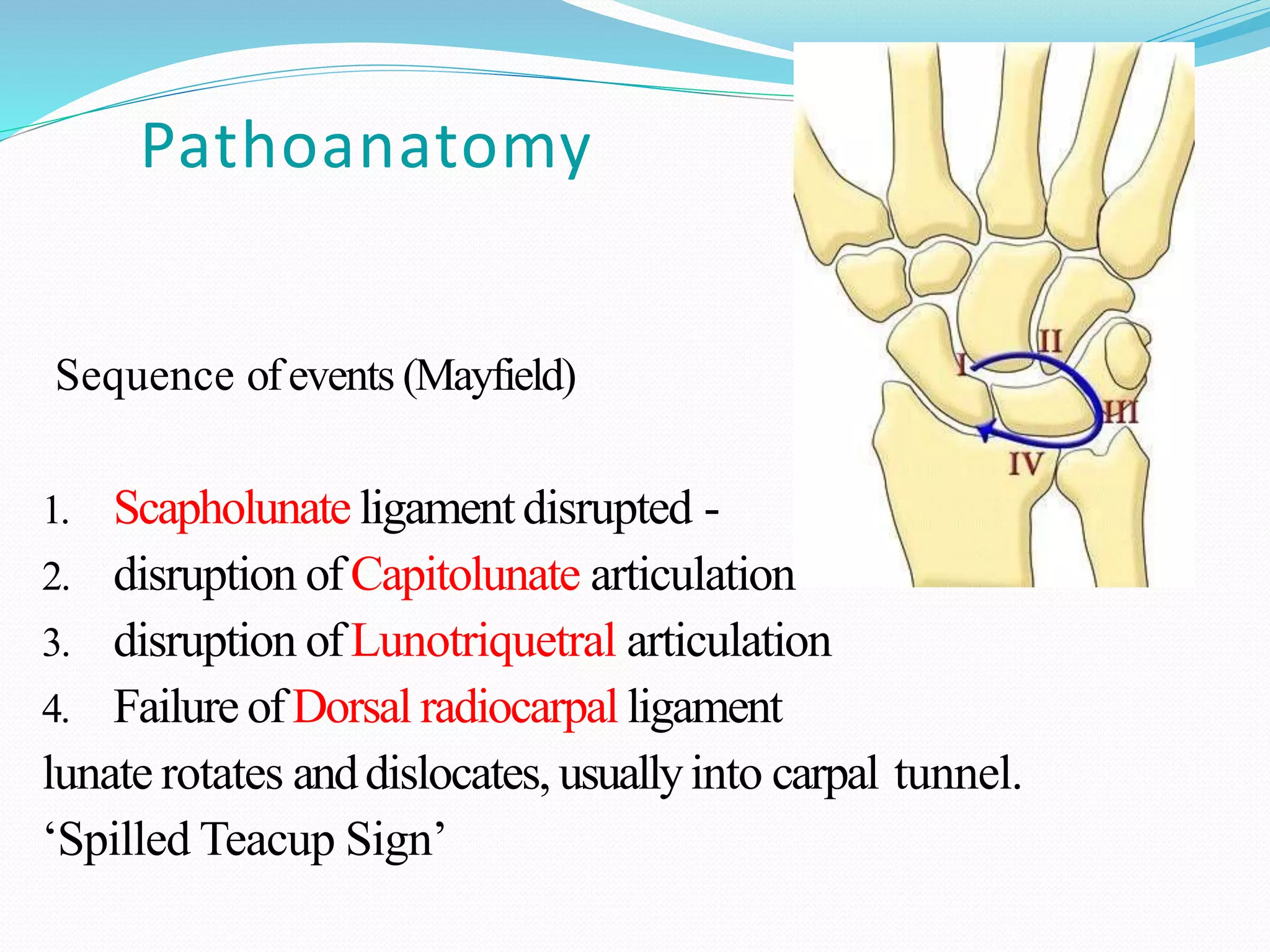 Carpal instability and perilunate dislocation | PPTX