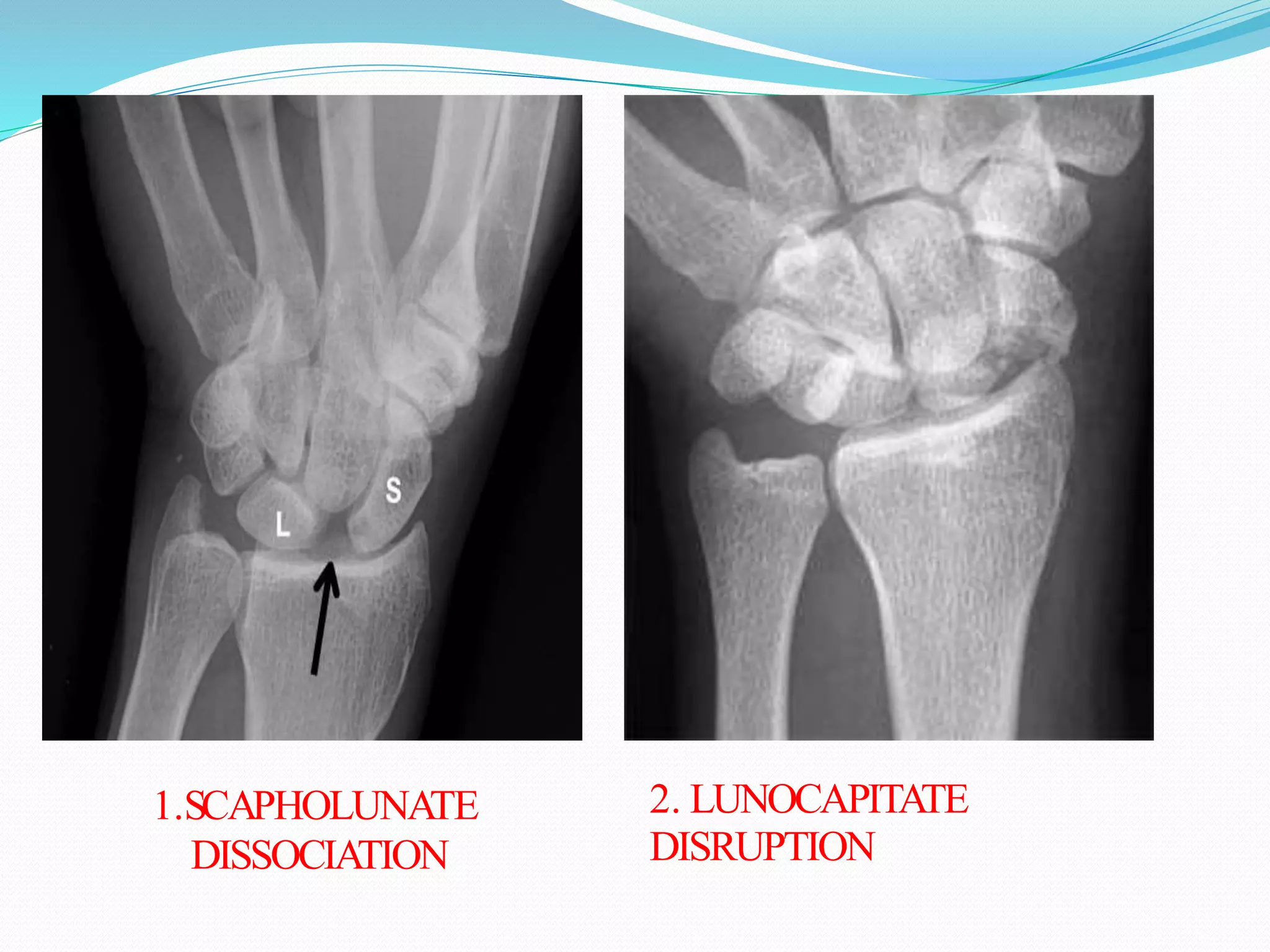 Carpal instability and perilunate dislocation | PPTX