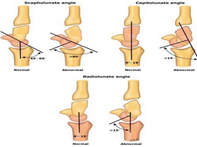 Carpal instability and perilunate dislocation | PPTX | Death, Injury ...