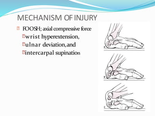 Carpal instability and perilunate dislocation | PPTX