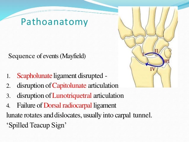 Carpal instability and perilunate dislocation