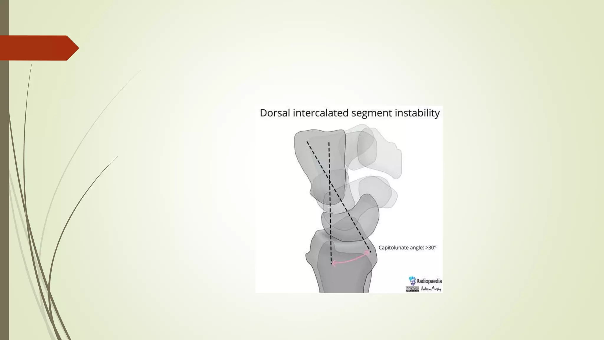 Carpal instability by dr Humayun.pptx