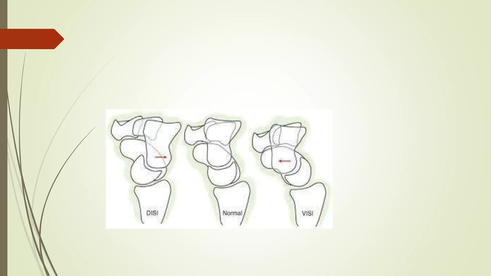 Carpal instability by dr Humayun.pptx