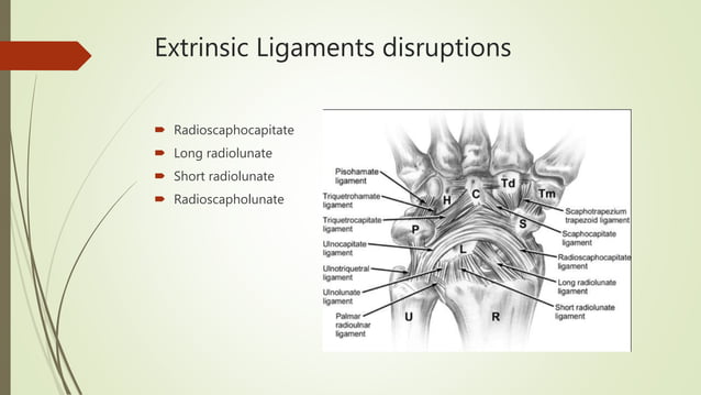Carpal instability by dr Humayun.pptx