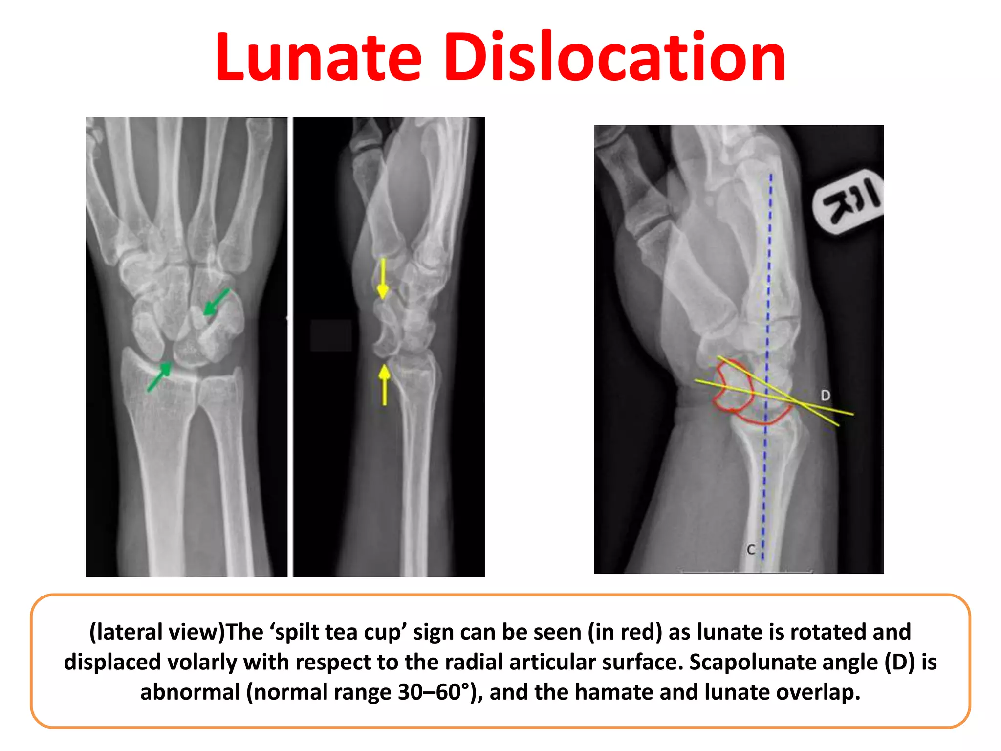 Carpal & Phalanges.pptx