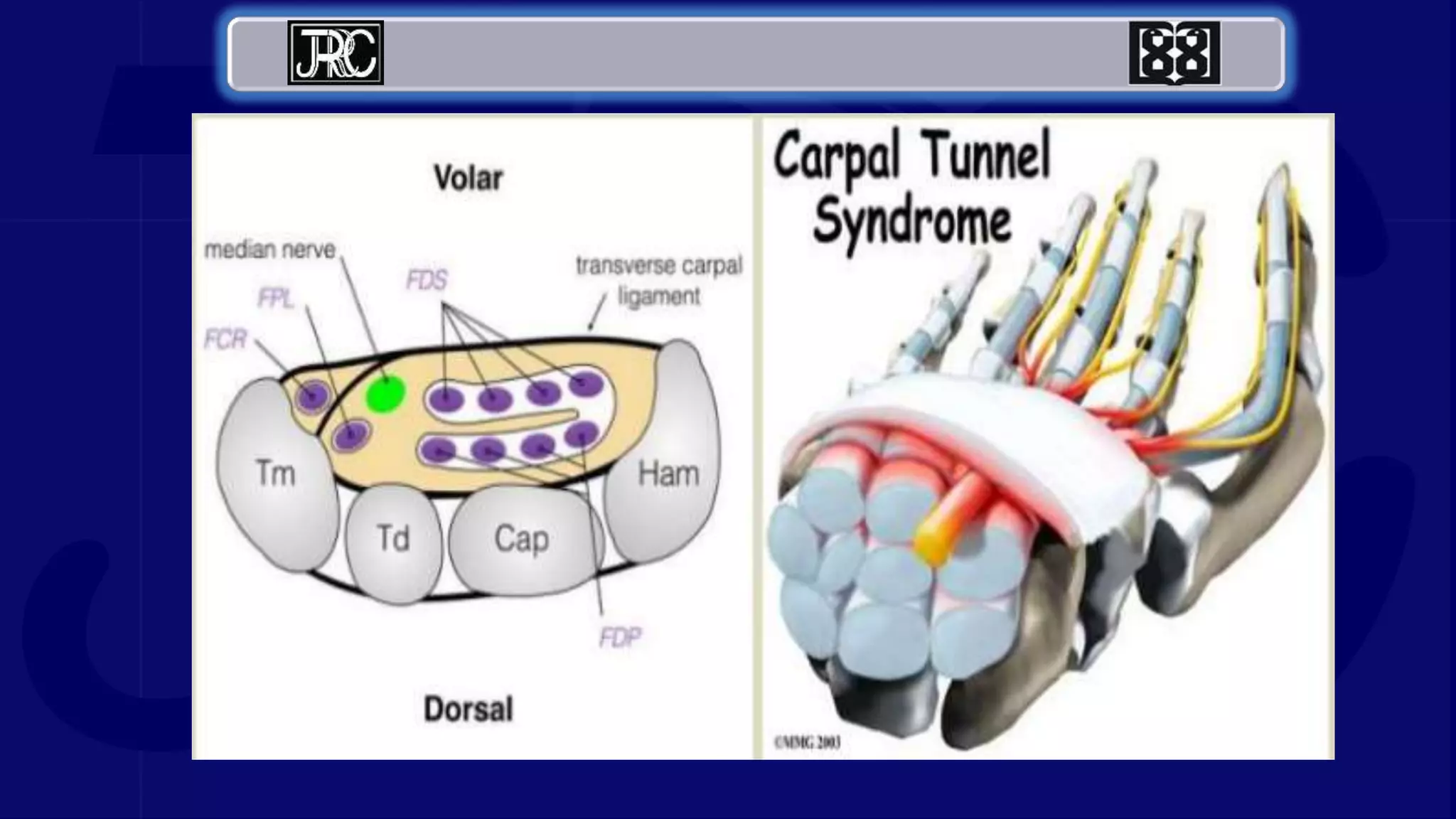 Carpal tunnel Syndrom, CTS | PPTX