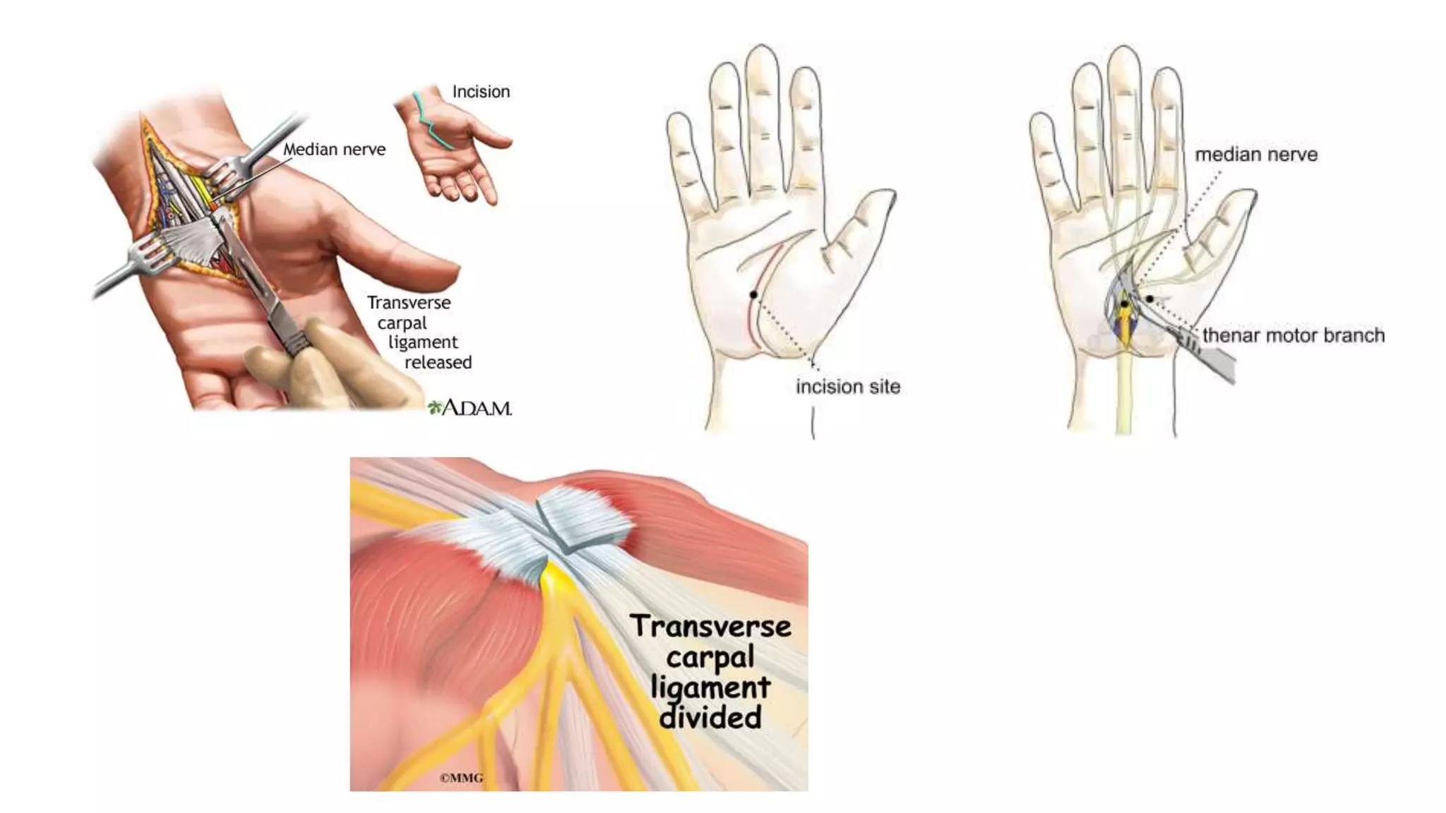 Carpal Tunnel Release | PPTX