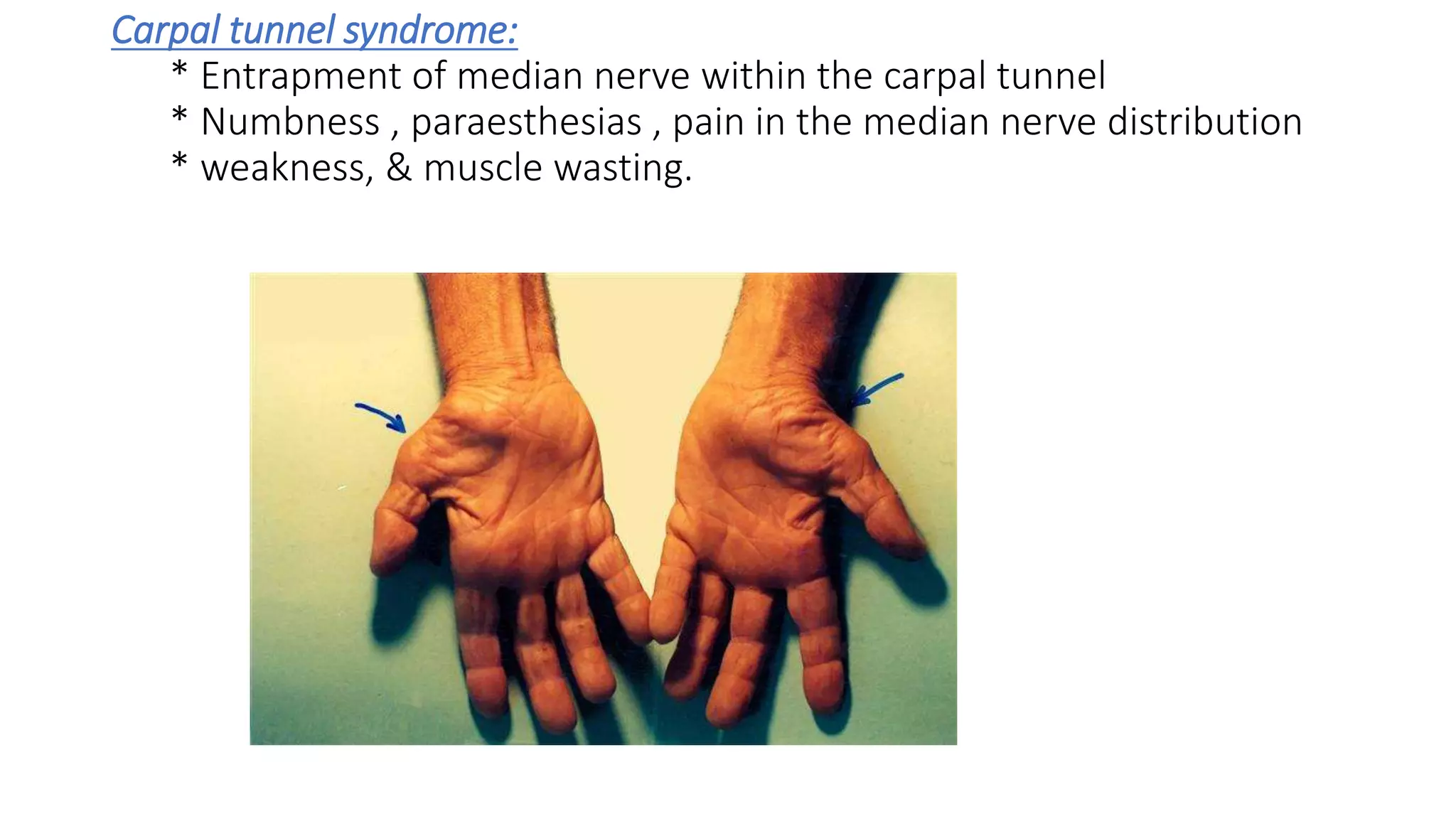 Carpal Tunnel Release | PPTX