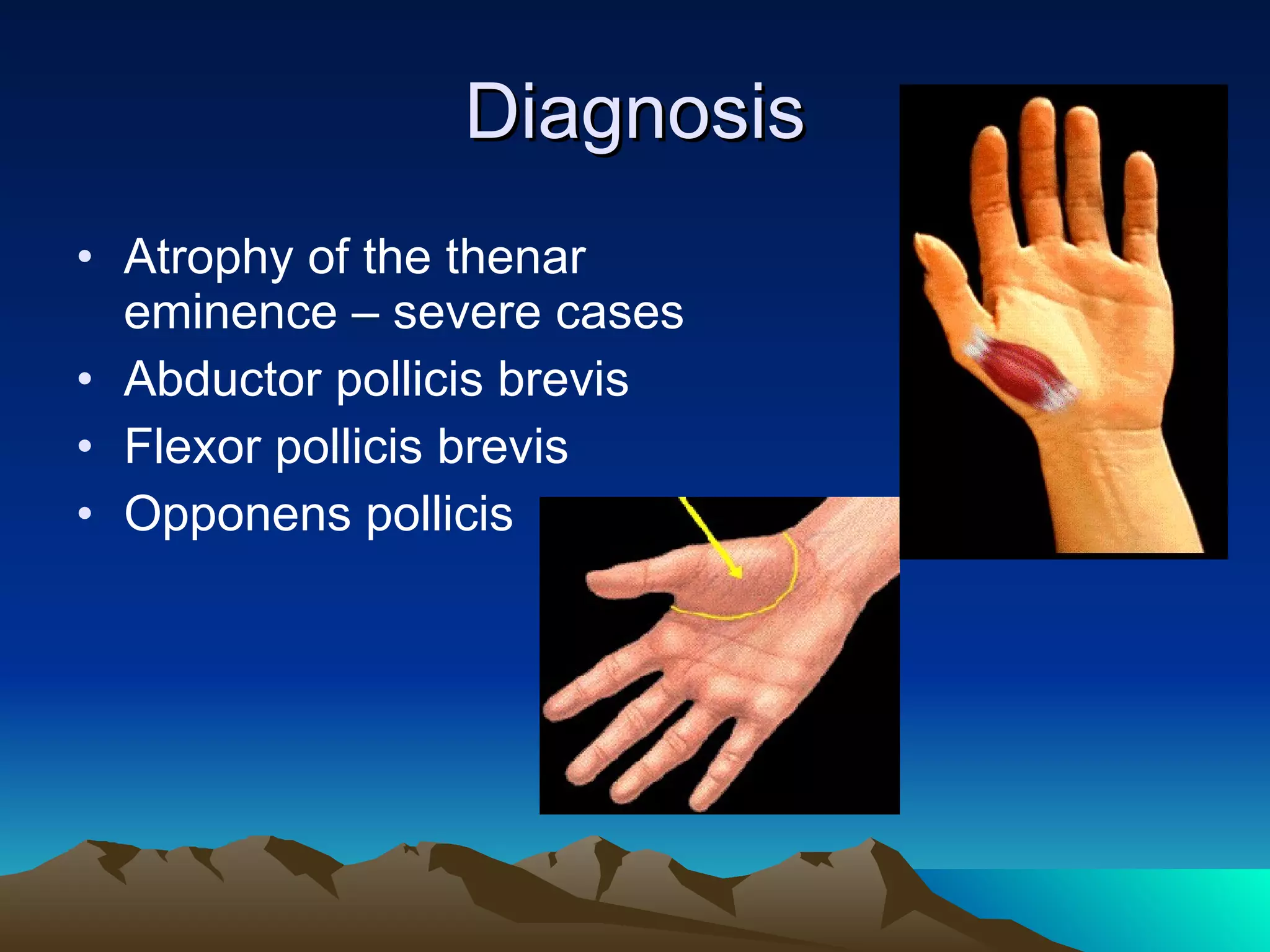 Carpal tunnel syndrome | PPT
