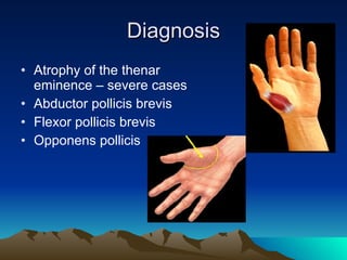 Carpal tunnel syndrome | PPT